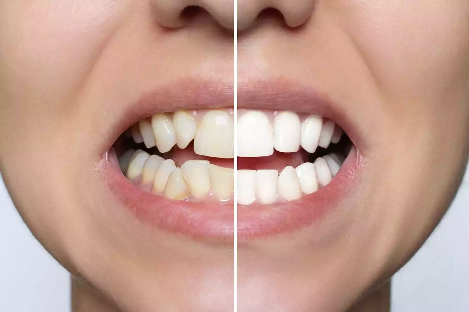 Crooked Teeth | Aesthetic General Dentistry of Frisco