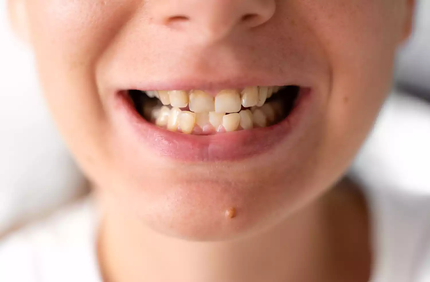 Misshapen Teeth | Aesthetic General Dentistry of Frisco